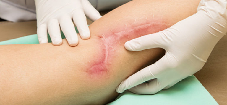 Scarring From Dog Bites - Dog Bite Lawyer serving Orange County